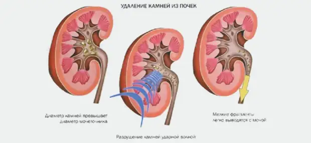 Бүйрек тастары: 10-ның 9-ы өздігінен шығуы мүмкін