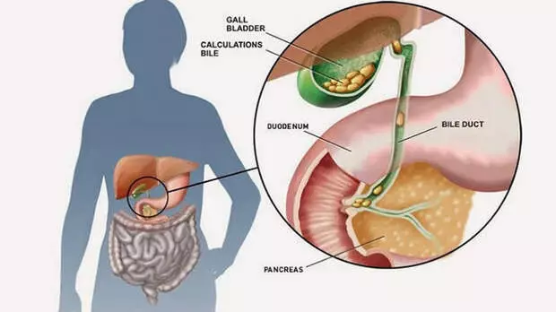 Otu esi agwọ ọrịa gallstone na ọgwụ ọdịnala