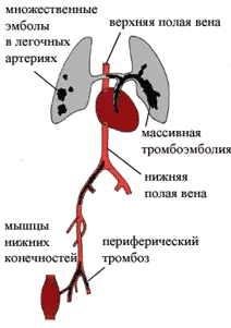 Thromboembolism nikibazo gishobora kwirindwa