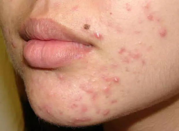 papules, pimples, blackheads, acne