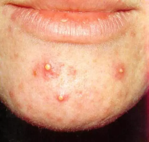 pustules