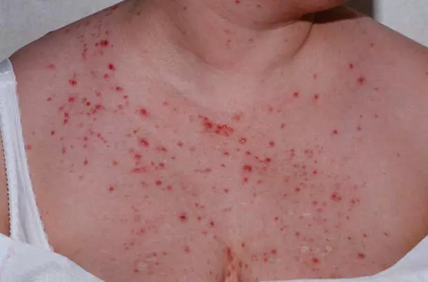 folliculitis fungas malassezia