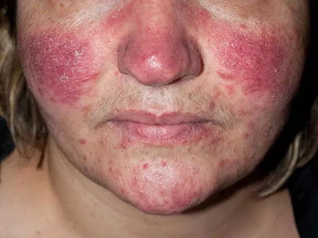 rosacea