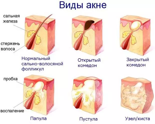 видове акне