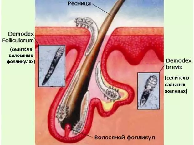 терідегі безеу кенесі Demodex